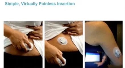 2021 EASD研究速递，全新CGMs多部位准确方便控糖医药新闻-ByDrug-一站式医药资源共享中心-医药魔方